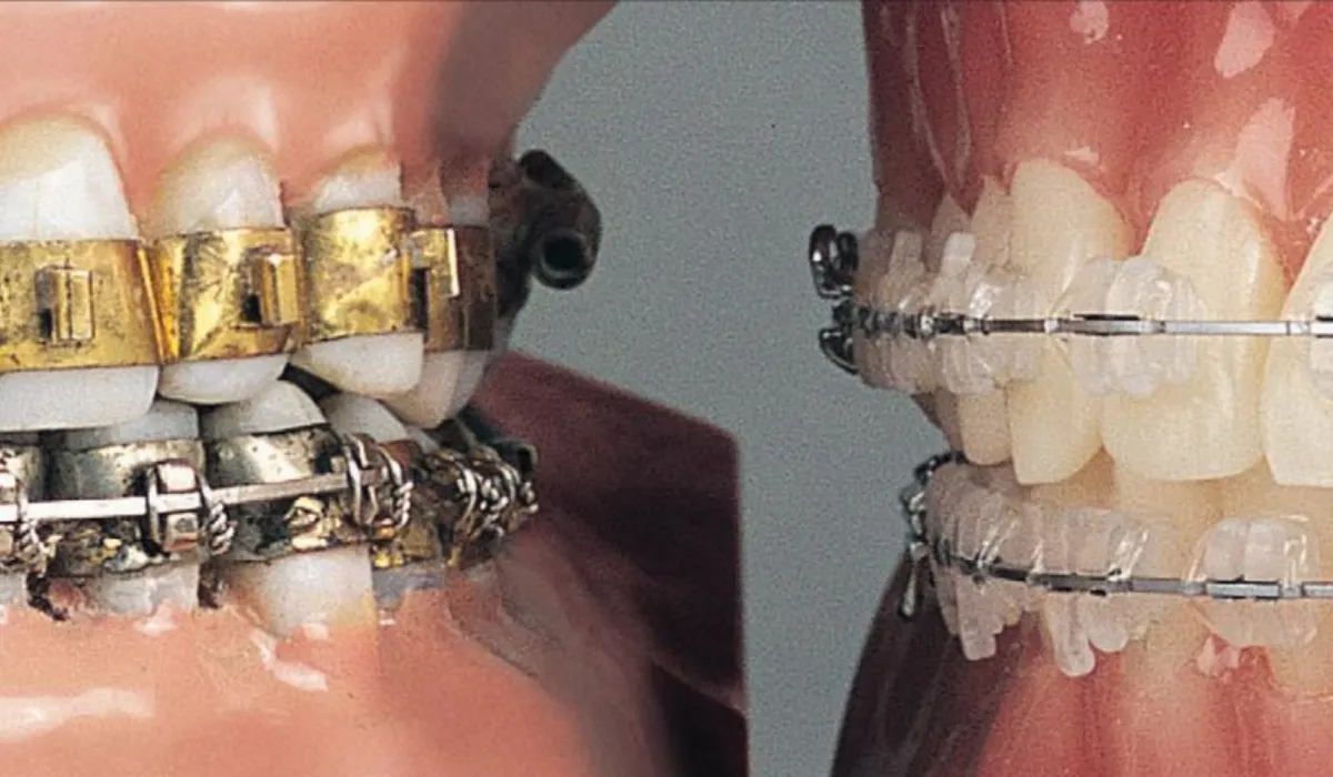 When Were Orthodontic Braces Invented? A Fascinating History