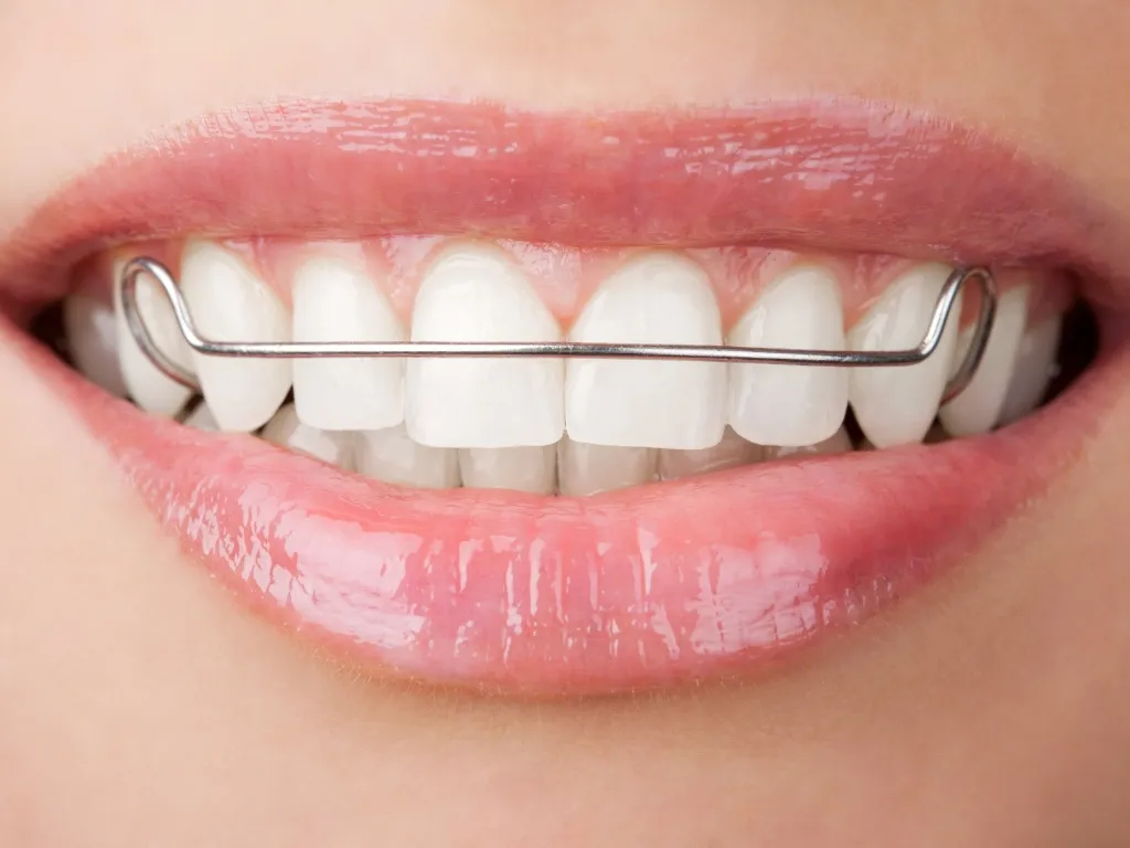 When Were Orthodontic Braces Invented? A Fascinating History