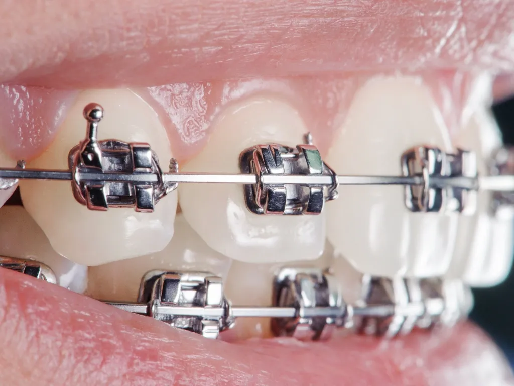 What Is Orthodontic Treatment? A Simple Guide